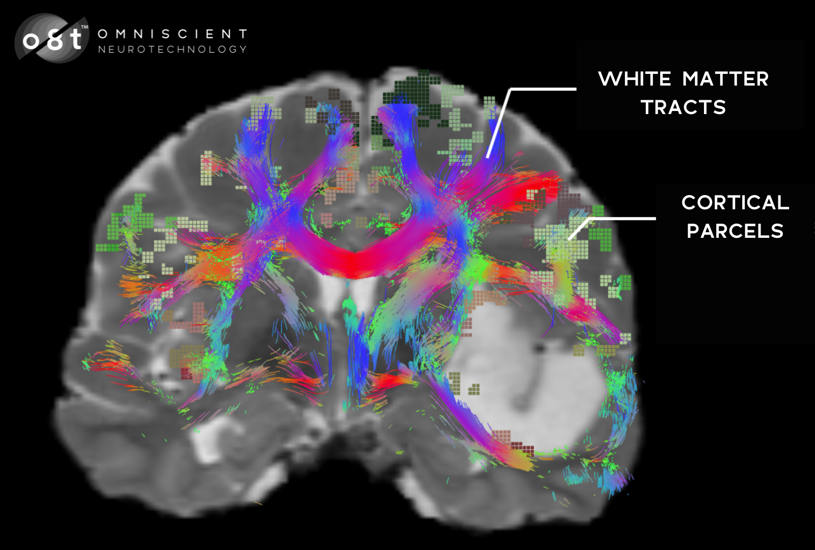 What is tractography?
